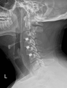 Disc Replacement Surgery Center | VSI