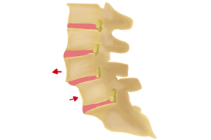 Segmental Instability and Hypermobile Spine Symptoms | VSI