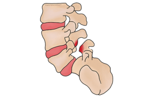 Diagnosing Spondylolysis I Symptoms & Treatment Options