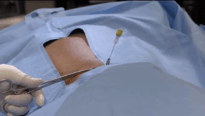 VIA Disc NP: Non-Surgical Solution for Back Pain | VSI